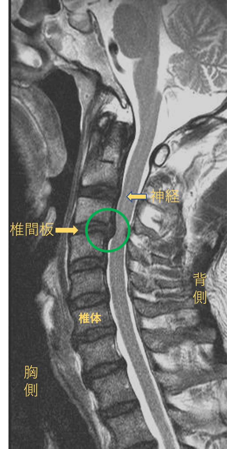 【PLDD法】10年前から両下肢のしびれがある60代男性【治療実績】 | 医療あれこれ日記 | 椎間板ヘルニアのレーザー治療 PLDD専門クリニック 伊東くりにっく