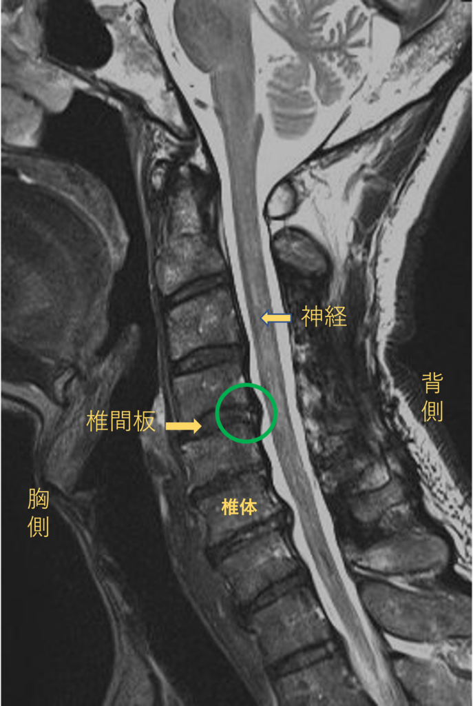 【PLDD法】右上肢の痛み、しびれがある60代女性【治療実績】 | 医療あれこれ日記 | 椎間板ヘルニアのレーザー治療 PLDD専門クリニック 伊東くりにっく