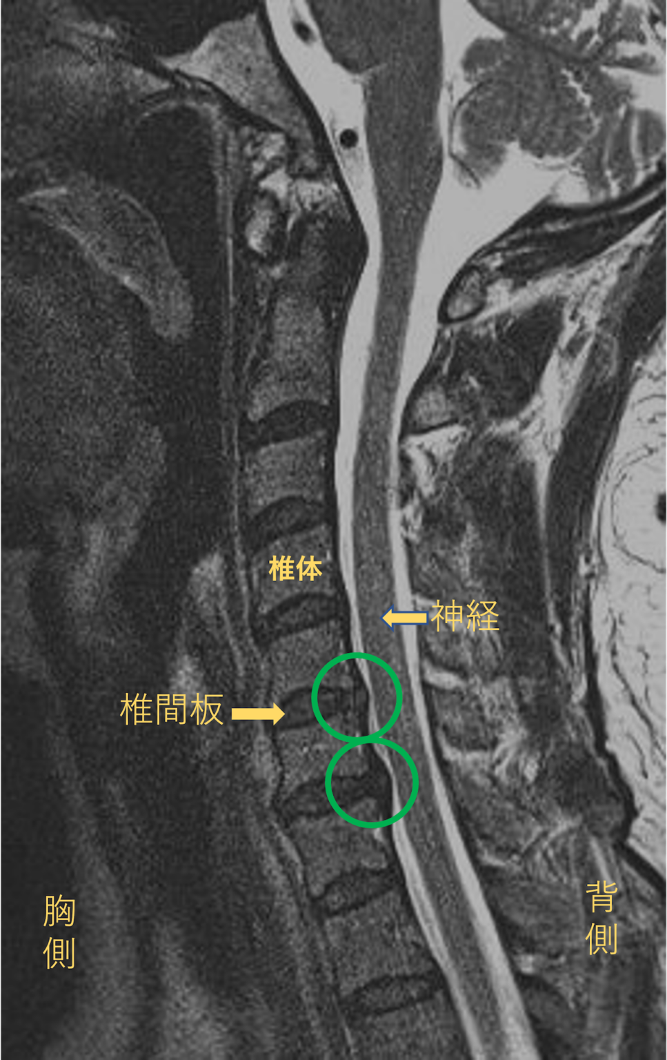 【PLDD法】半年前から首に激痛があり、左手のしびれがある40代女性【治療実績】 | 医療あれこれ日記 | 椎間板ヘルニアのレーザー治療 PLDD専門クリニック 伊東くりにっく