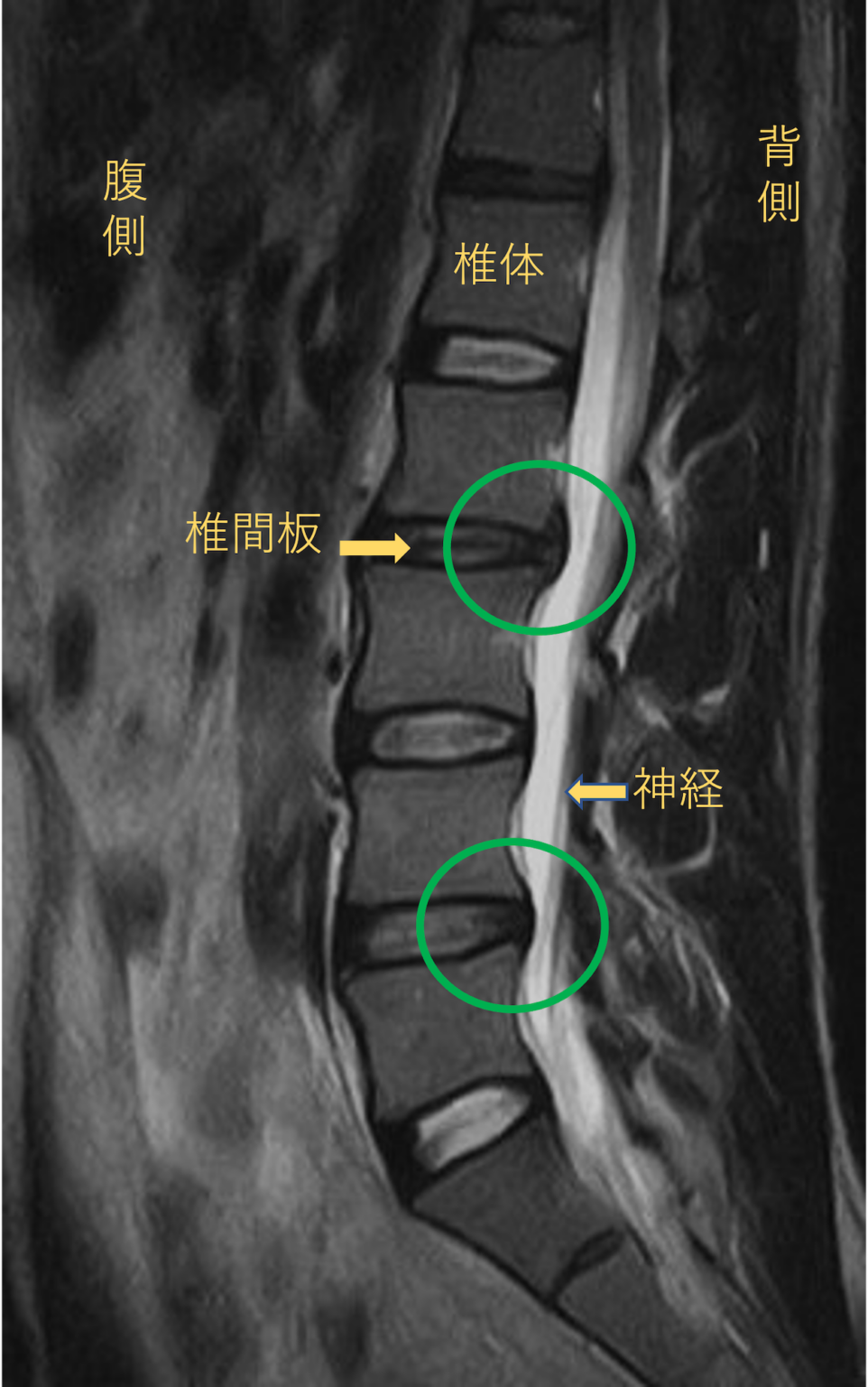 【PLDD法】1年前から腰痛、右下肢のしびれがある40代男性【治療実績】 | 医療あれこれ日記 | 椎間板ヘルニアのレーザー治療 PLDD専門クリニック 伊東くりにっく