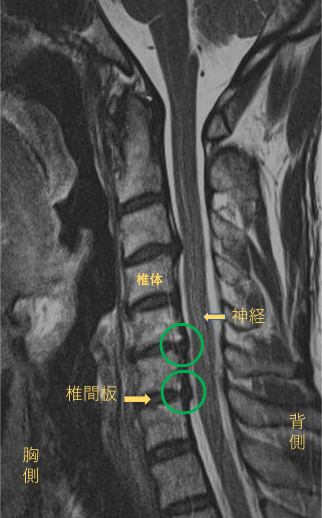 【PLDD法】右下肢の痛み、しびれがある40代男性【治療実績】 | 医療あれこれ日記 | 椎間板ヘルニアのレーザー治療 PLDD専門クリニック 伊東くりにっく