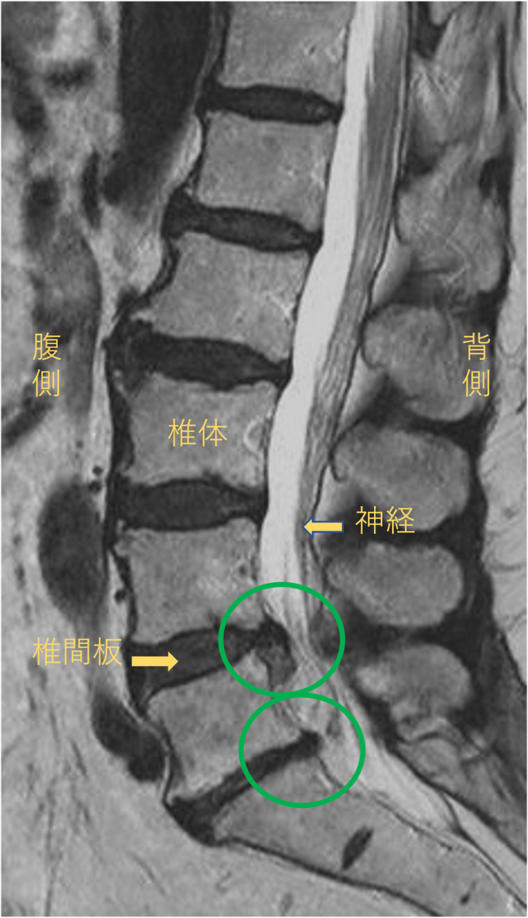 【PLDD法】1年前から左下肢の痛み、しびれがある70代女性【治療実績】 | 医療あれこれ日記 | 椎間板ヘルニアのレーザー治療 PLDD専門 ...