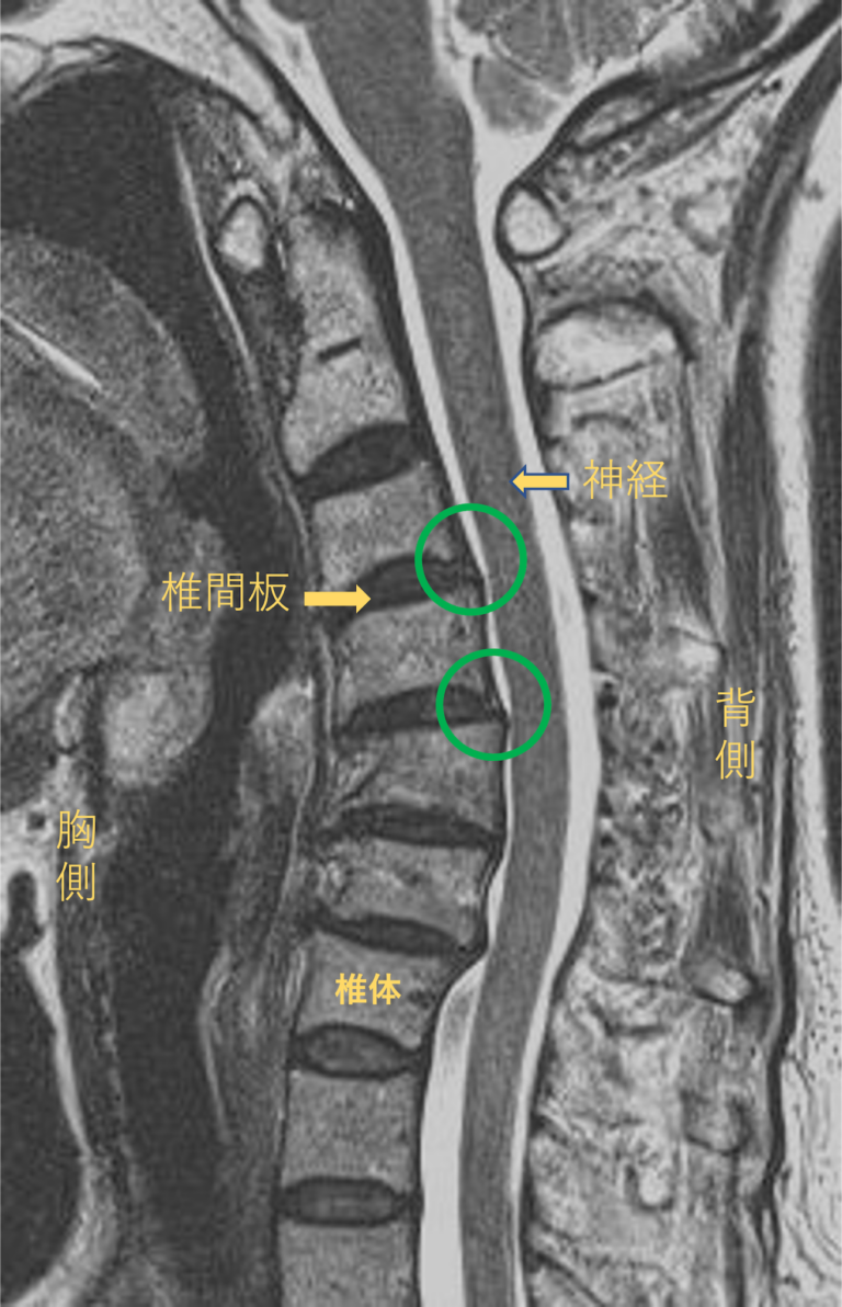 【PLDD法】首から肩の痛みがある60代女性【治療実績】 | 医療あれこれ日記 | 椎間板ヘルニアのレーザー治療 PLDD専門クリニック 伊東くりにっく