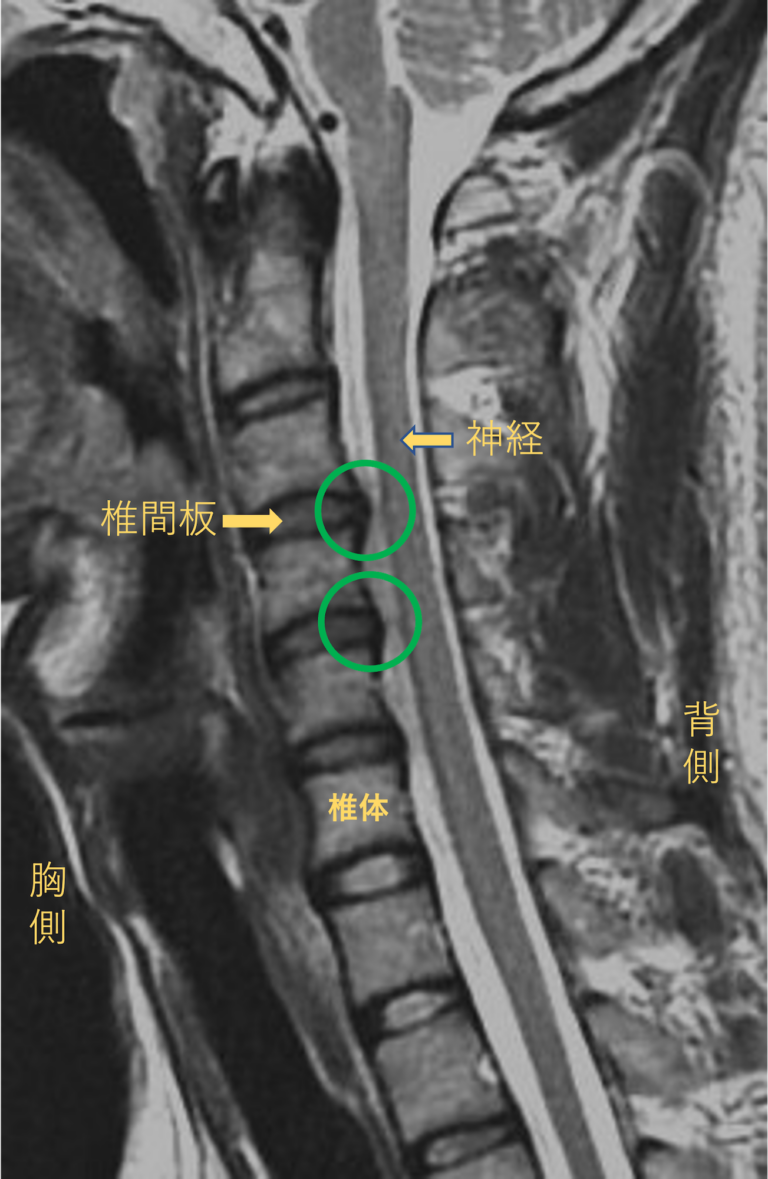 【PLDD法】3か月前から首から左上肢の痛み、めまいがある30代男性【治療実績】 | 医療あれこれ日記 | 椎間板ヘルニアのレーザー治療 PLDD専門クリニック 伊東くりにっく