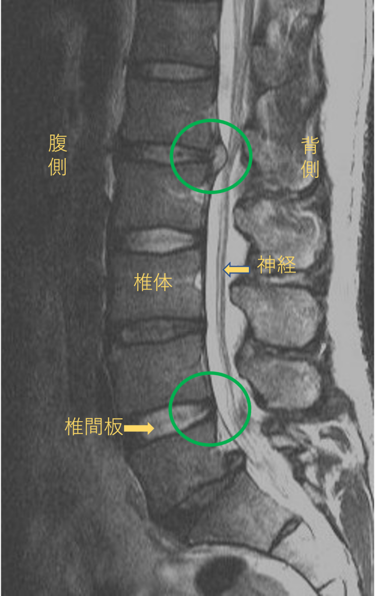 【PLDD法】1年前から両下肢の痛み、しびれがある40代男性【治療実績】 | 医療あれこれ日記 | 椎間板ヘルニアのレーザー治療 PLDD専門クリニック 伊東くりにっく