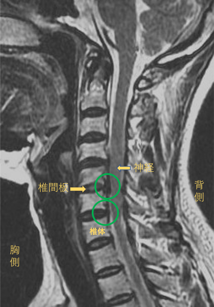 【PLDD法】1年前から左頚部から左上肢の痛み、しびれがある40代女性【治療実績】 | 医療あれこれ日記 | 椎間板ヘルニアのレーザー治療 PLDD専門クリニック 伊東くりにっく