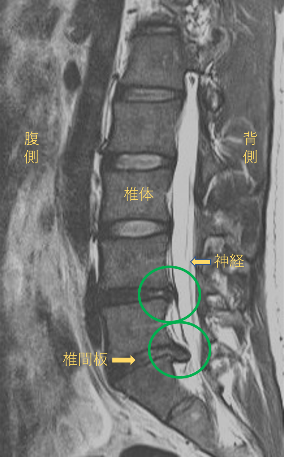 【PLDD法】4か月前から左下肢の痛み、しびれがある30代男性【治療実績】 | 医療あれこれ日記 | 椎間板ヘルニアのレーザー治療 PLDD専門クリニック 伊東くりにっく