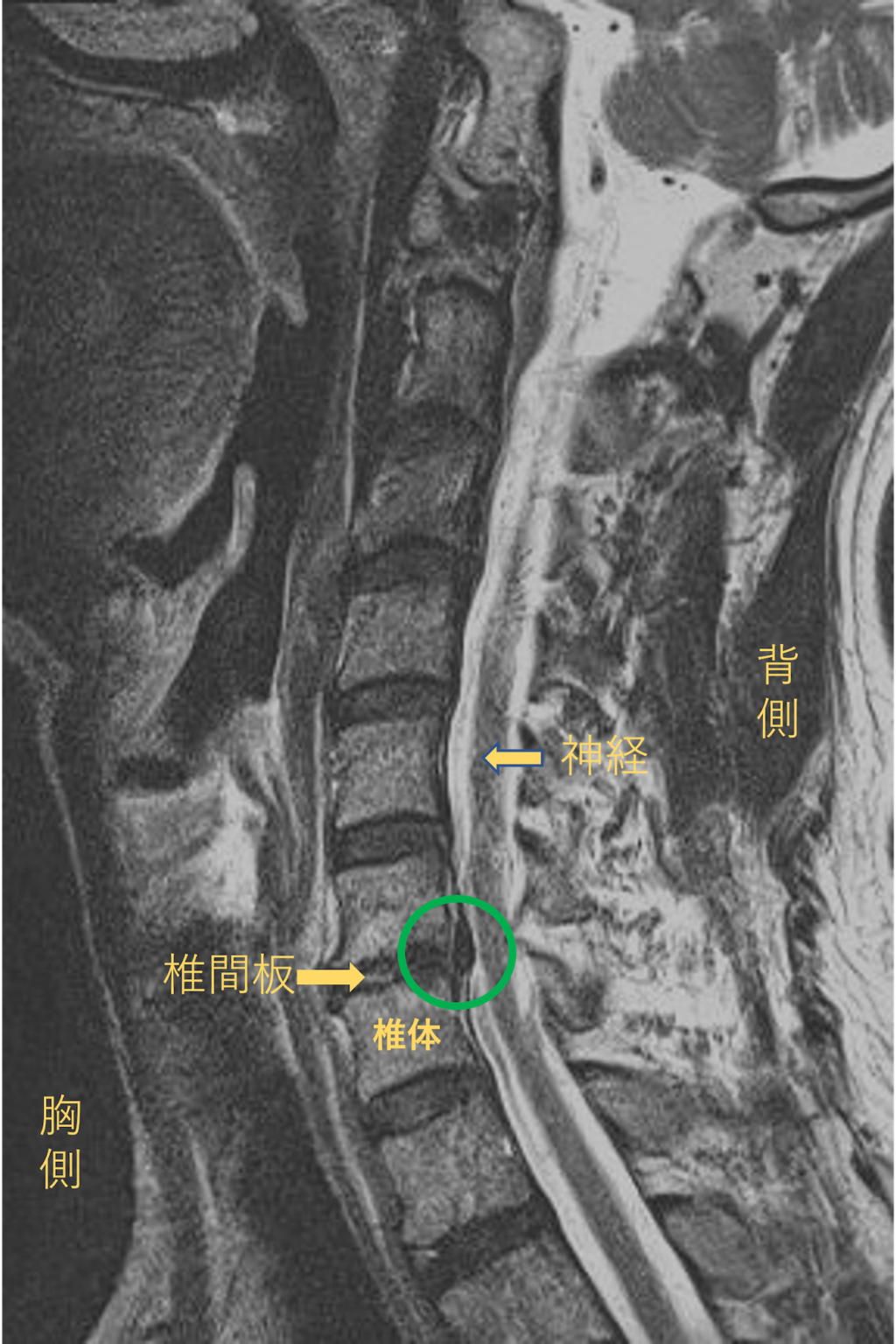 【PLDD法】左上肢の痛み、しびれがある50代男性【治療実績】 | 医療あれこれ日記 | 椎間板ヘルニアのレーザー治療 PLDD専門クリニック 伊東くりにっく