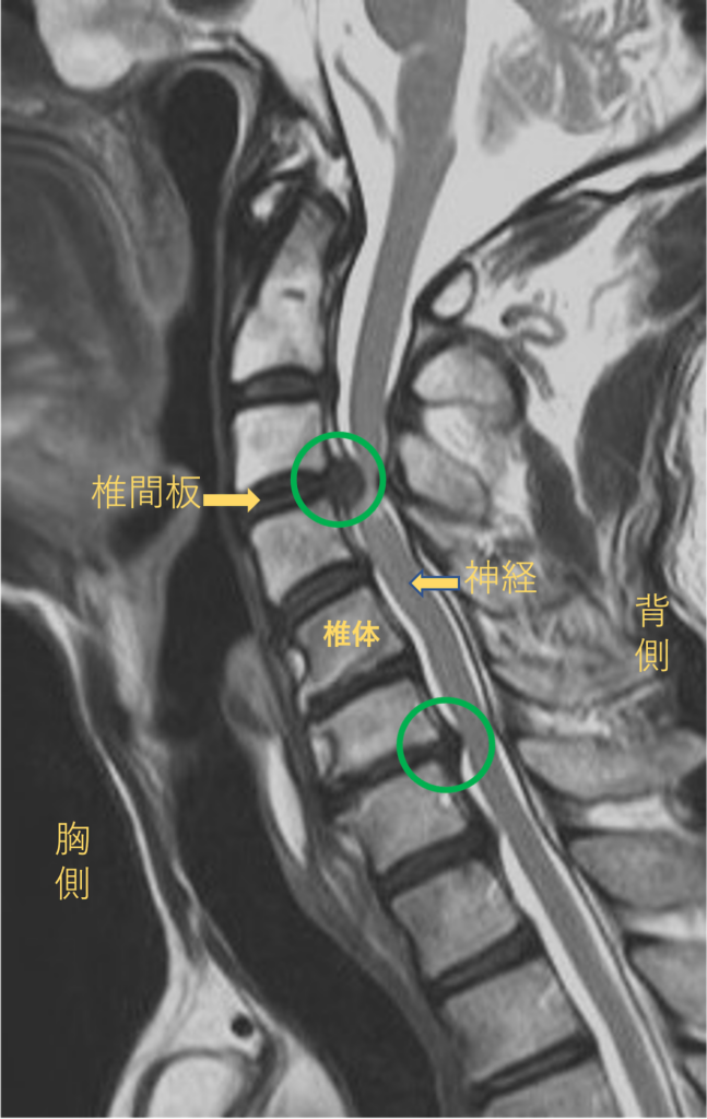 【PLDD法】2年前から両上肢のしびれ、両下肢の脱力感がある70代男性【治療実績】 | 医療あれこれ日記 | 椎間板ヘルニアのレーザー治療 PLDD専門クリニック 伊東くりにっく